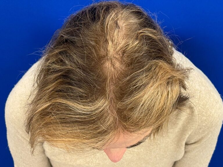 Advanced Hair Restoration Tech & Hair Transplant for Women